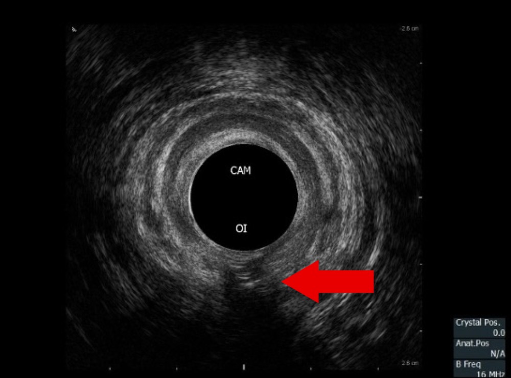 Manometría anorrectal 3D en paciente con incontinencia fecal pasiva ...