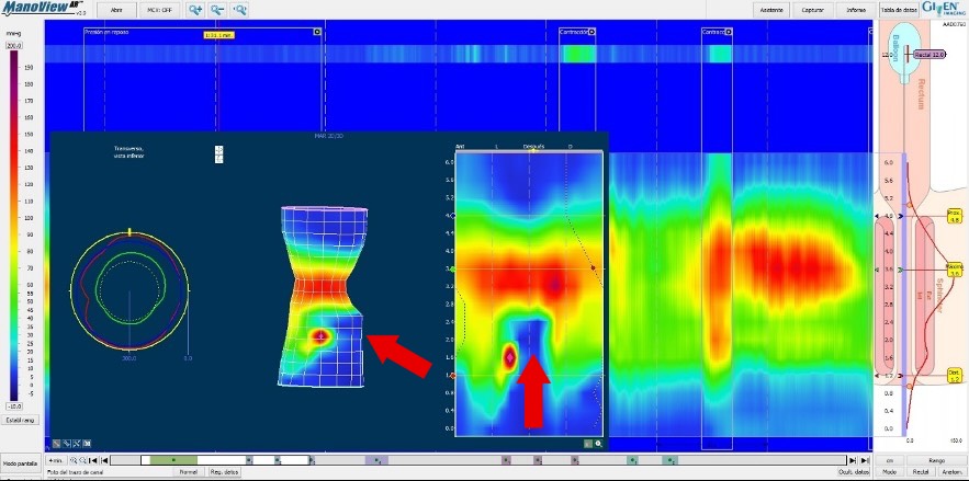 Manometría anorrectal 3D en paciente con incontinencia fecal pasiva ...