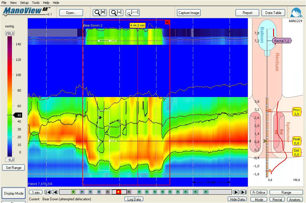 Manometría anorrectal de AR en el estreñimiento crónico funcional ...